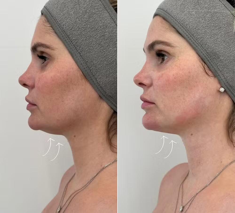 Cenapop · Bárbara Evans mostra antes e depois de diminuir a papada ...