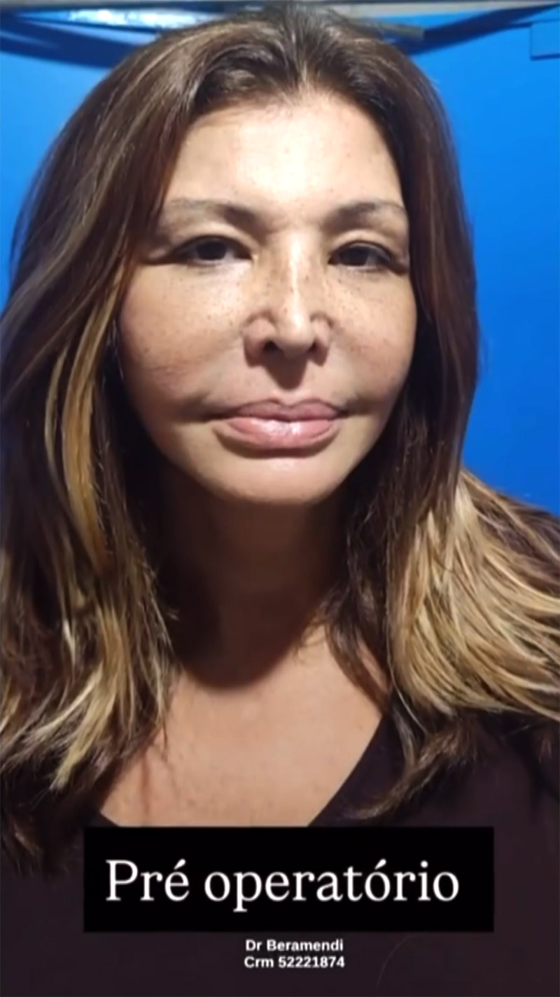 Cenapop · Roberta Close recorre à harmonização facial aos 60 anos: veja ...