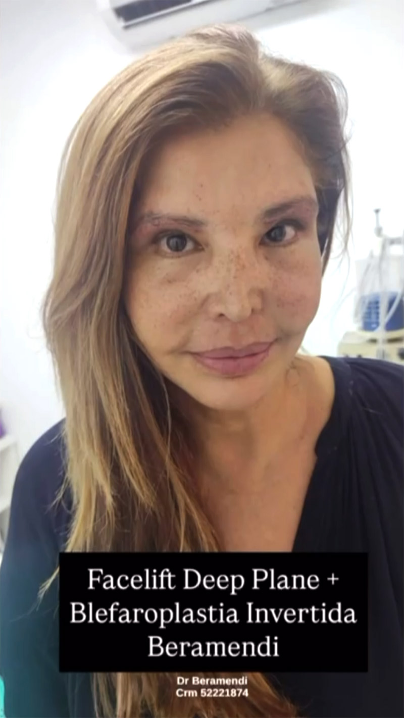 Cenapop · Roberta Close recorre à harmonização facial aos 60 anos: veja ...